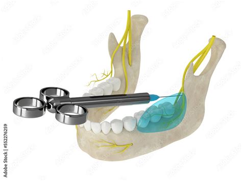 Photo And Art Print Mandibular Arch With Buccal Nerve Block Aleksandra