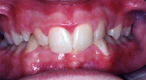 7 Common Bite Problems American Association Of Orthodontists