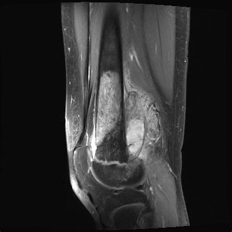 Osteosarcoma Knee Mri
