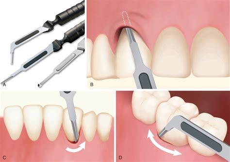 Apical Microsurgery Pocket Dentistry