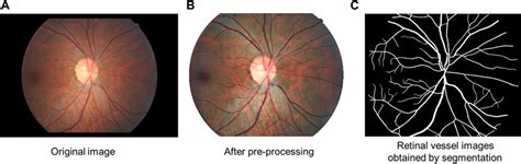 frontiers relationships between quantitative retinal microvascular
