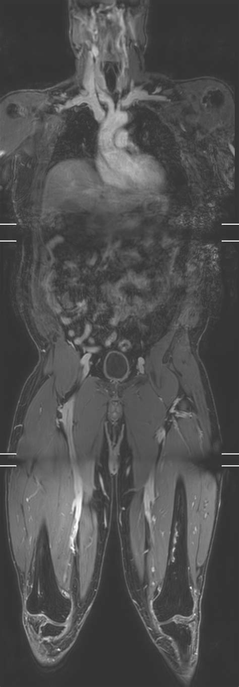 Last One For Today You May Have Never Seen Plexiform Lesion Of