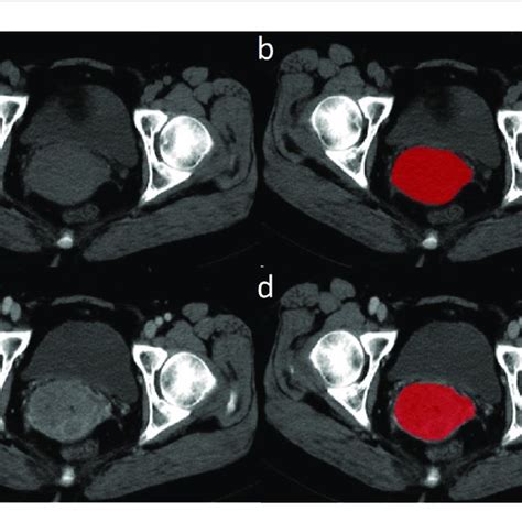Illustration Of Tumor Segmentation On The Maximum Level Of Tumor A Download Scientific