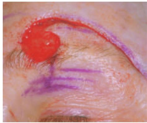 Defect Following Mohs Micrographic Surgery