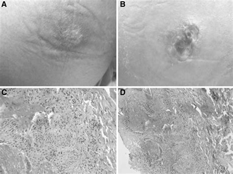 Bullous Pyoderma Gangrenosum Associated With Hairy Cell Leukemia And Its Complete Response To