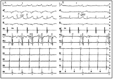 Intermittent Atrioventricular Block In An Accessory Pathway Associated
