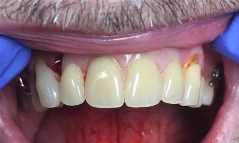 Partial Denture Pictures Before And After At Alfredo Montano Blog Partial Denture Pictures Before And After At Alfredo Montano Blog