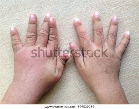 Bug Bite Swelling Hand