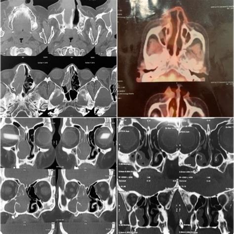 Ct Scans Before A And After Surgery B Draf Iii Procedure Involves