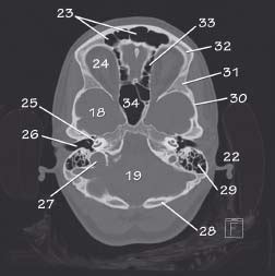 Head Ct Anatomy Radiology Key