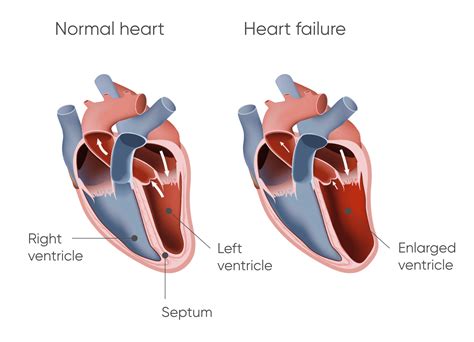 Heart Failure A Chronic Inflammatory And Progressive Disease