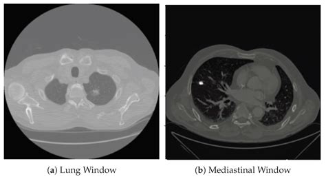 Optimal Thresholding For Multi Window Computed Tomography Ct To
