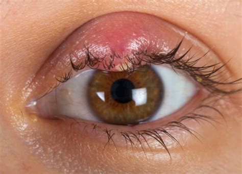 Difference Between Hordeolum And Chalazion And Blepharitis 2