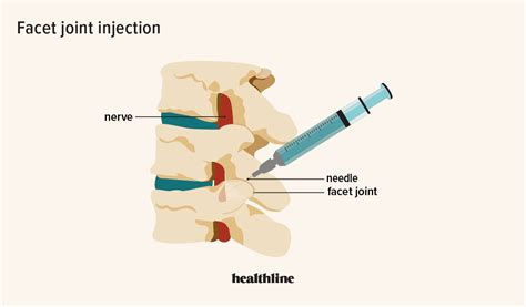 Your Guide To Facet Joint Injections And Recovery