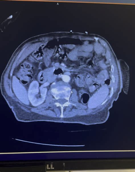 Just A Tiny Renal Cyst R Radiology