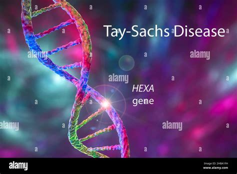 Tay Sachs Disease Illustration A Genetic Disorder That Progressively