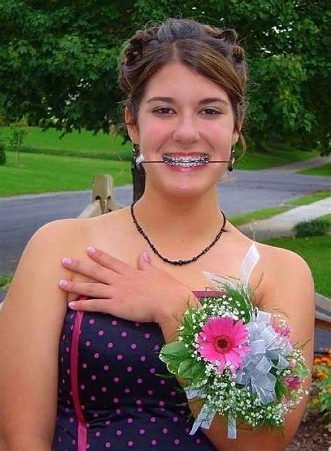 Pin On Headgear Braces Girls Teeth Braces Adult Braces