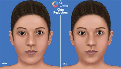 Genioplasty