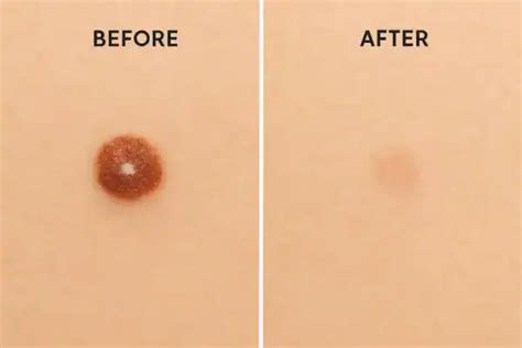 Best Dermatofibroma Removal Treatment In Uk