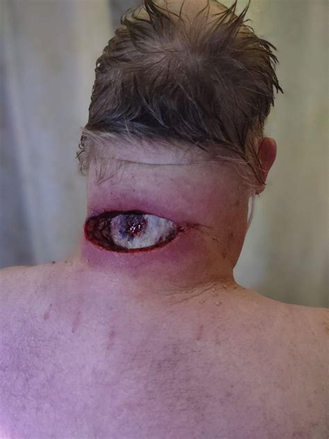 My Uncles Infected Neck Cyst Rmakemesuffer