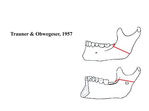 Mandibular Deformities And Their Management Pptx