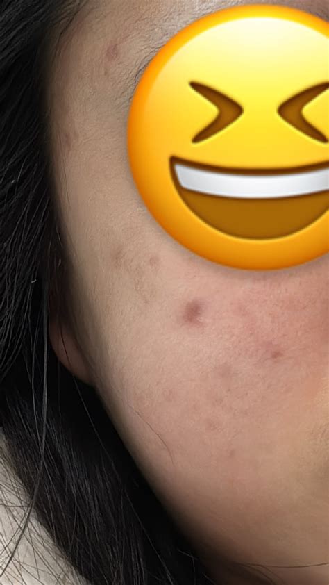 여드름흉터 셀프관리 지식in