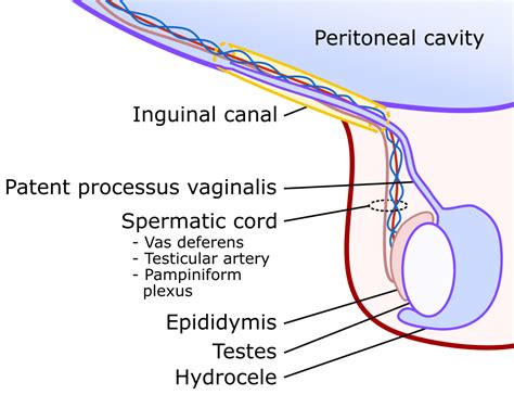 Hydrocele Scrotal Lump Geeky Medics