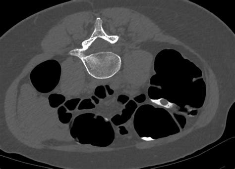 Clinical Case Incomplete Screening Colonoscopy Mdct Net Slug Preview