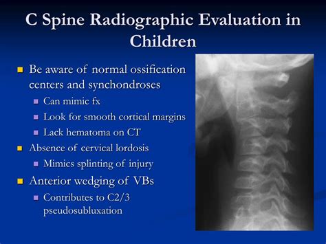 Ppt Pediatric C Spine Trauma Clearing The C Spine Powerpoint
