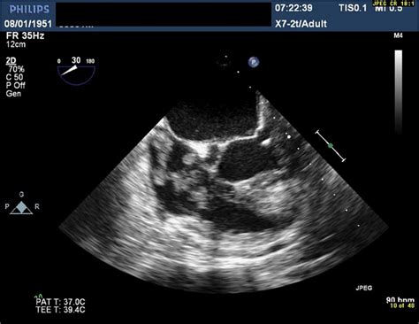 Pacemaker Lead Associated Thrombosis In Cardiac Resynchronisation Therapy Bmj Case Reports