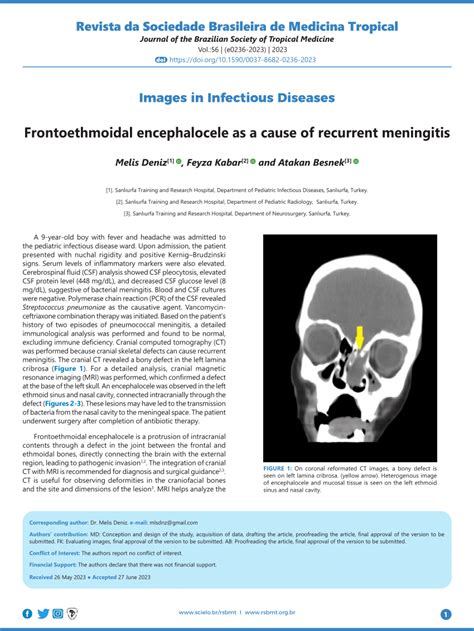 Pdf Frontoethmoidal Encephalocele As A Cause Of Recurrent Meningitis