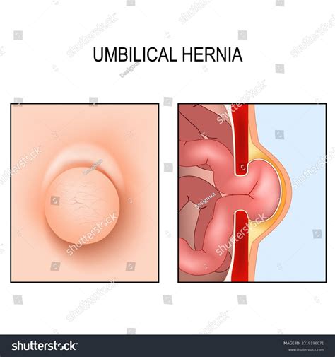 Umbilical Hernia Cross Section Abdomen Small Stock Vector Royalty Free 2219196071 Shutterstock