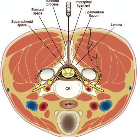 Pdf Safeguards To Prevent Neurologic Complications After Epidural