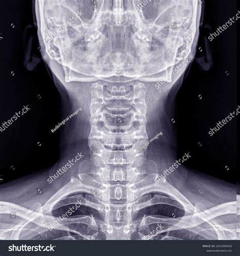 Xray Cspine Xray Image Cervical Spine Stock Photo 2251049343 Shutterstock