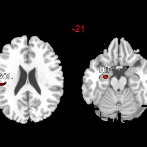 Statistical Parametric Mapping Regions Superimposed On A Download Scientific Diagram