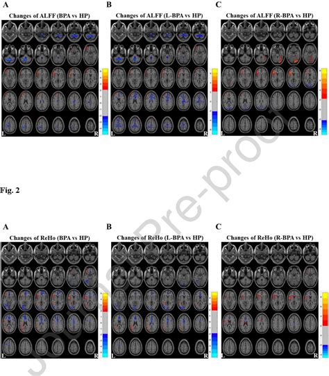 Figure 2 From Altered Intrinsic Brain Activity In Patients With