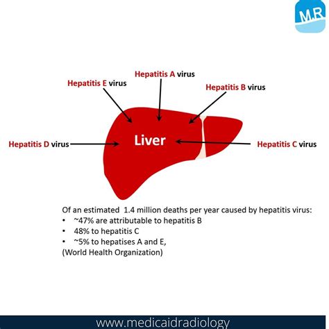 Hepatitis A Liver