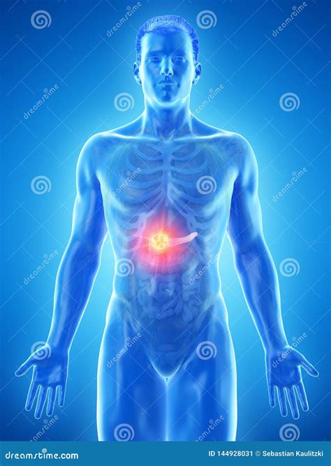 Sirve El Tumor Del P?ncreas Stock de ilustración - Ilustración de exacto, salud: 144928031