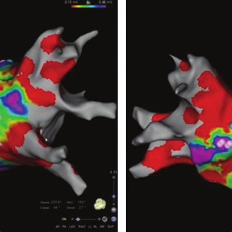 Stages Of Left Atrial Tissue Fibrosis On Cardiac Mri Download