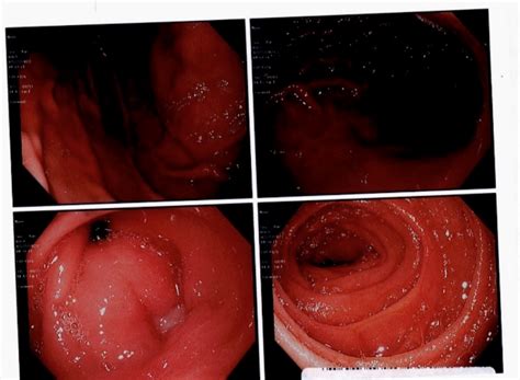 Canceled Amidst The Storm Recognizing Thyroid Storm Before Undergoing