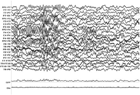 Sample EEG Recording From CHB MIT Database Download Scientific Diagram