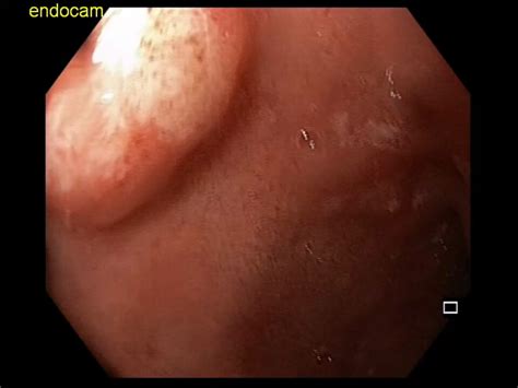 [video] Gurhan Sisman On Linkedin Net In Duodenum Nice And Gently Endoscopic Submucosal
