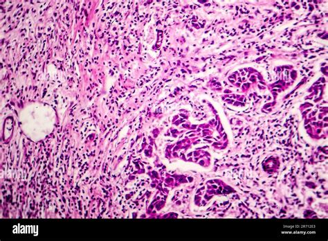 Lymph Node Metastasis Light Micrograph Of Cancer That Has Spread To A