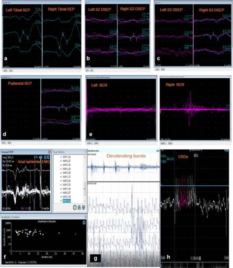 Applications Of Pelvic Neurophysiology Testing In Patients With Voiding Download Scientific
