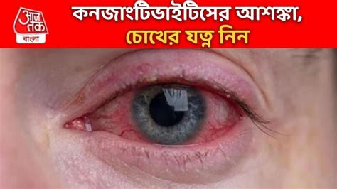 Conjunctivitis Reason কনজাংটিভাইটিস থেকে কীভাবে বাঁচবেন রইল উপায়