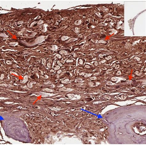 Higher Magnification Image Of The Center Of The Bony Defect Showing The Higher Magnification Image Of The Center Of The Bony Defect Showing The