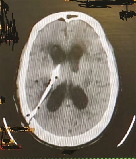 Wrong Trajectory Of Shunt Using Conventional Method Download Scientific Diagram