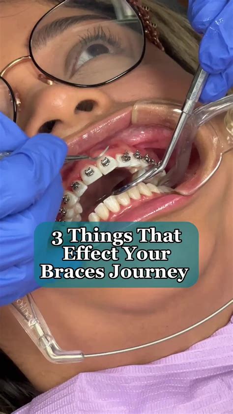 Removing Braces 🎉 Cute Braces Orthodontics Braces Braces Off