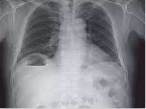 Pyogenic Liver Abscess Pptx