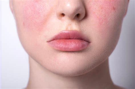 Rosacea Diffuse Redness Treatments West Vancouver Bn Skin And Lase